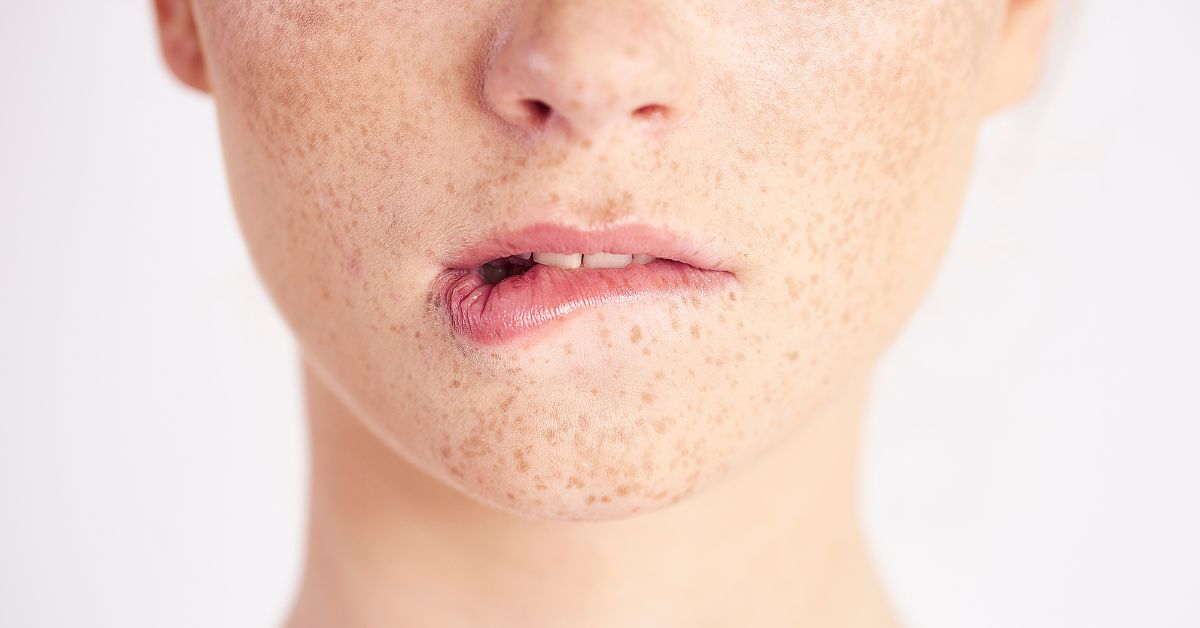 Czym są piegi i czy mogą być przeciwwskazaniem do depilacji?